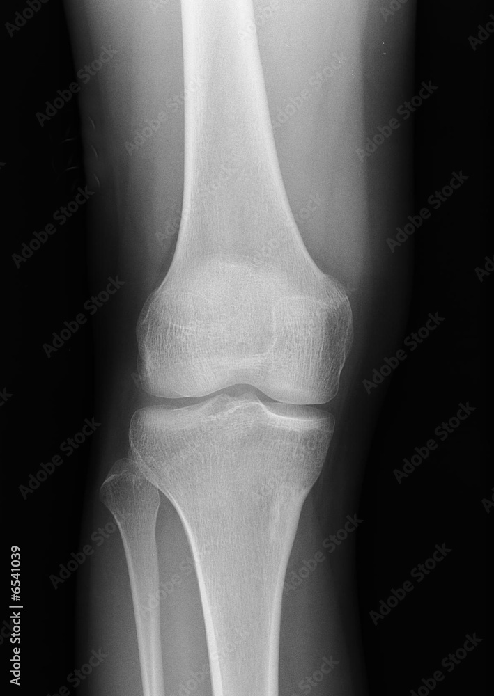 Radio de genou de face Photos | Adobe Stock