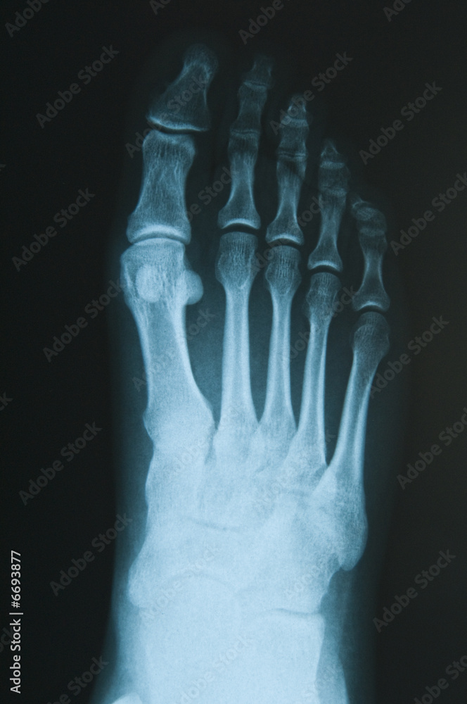 Radiografia del piede Stock Photo | Adobe Stock