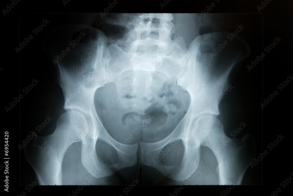 Pelvis X-ray Stock Photo | Adobe Stock