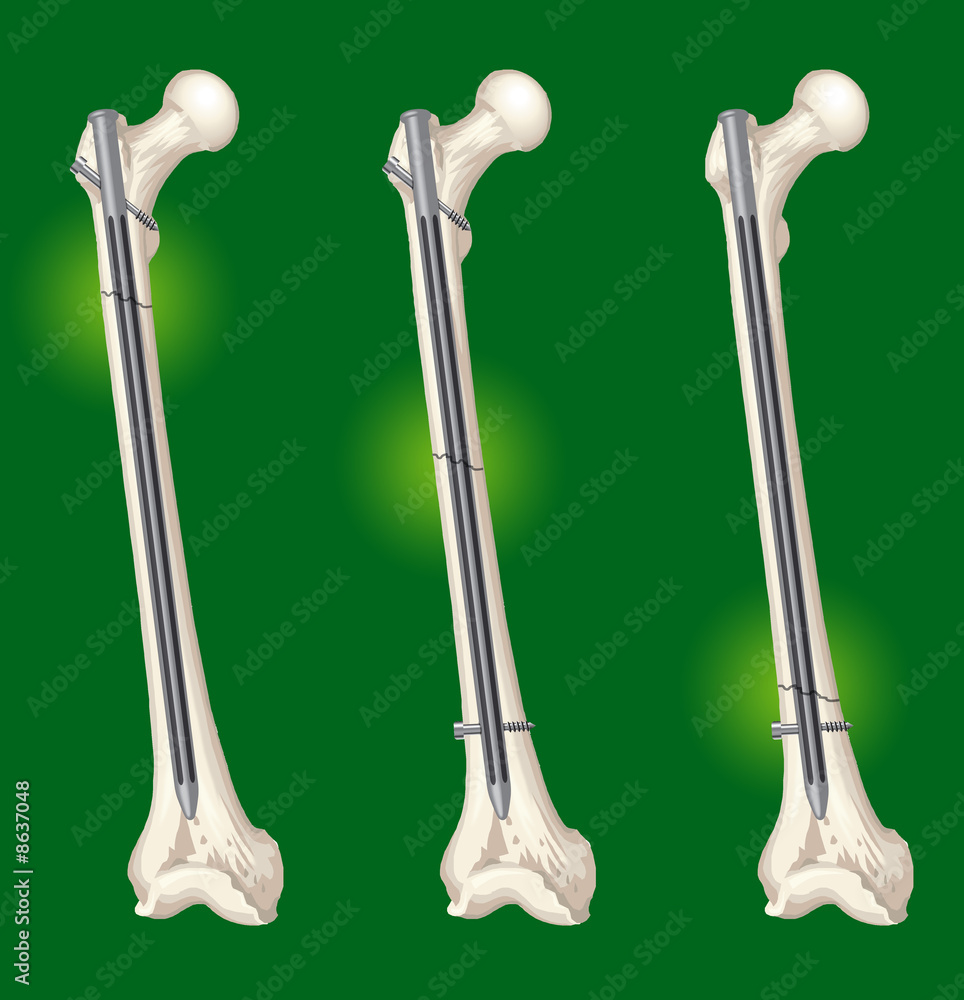 fratture del femore Stock Illustration | Adobe Stock