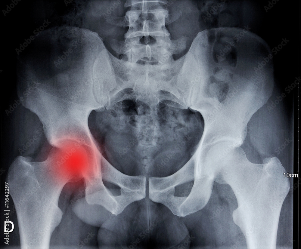 douleur au col du femur Stock Photo | Adobe Stock