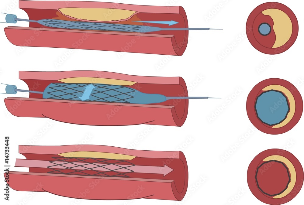 stent Stock Vector | Adobe Stock