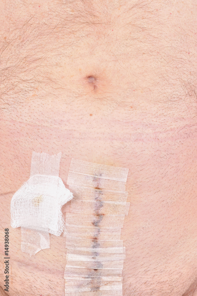 Prostate Cancer Surgery Operation Stock Photo | Adobe Stock