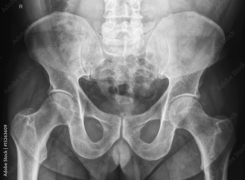 Eck N Of Men X Ray