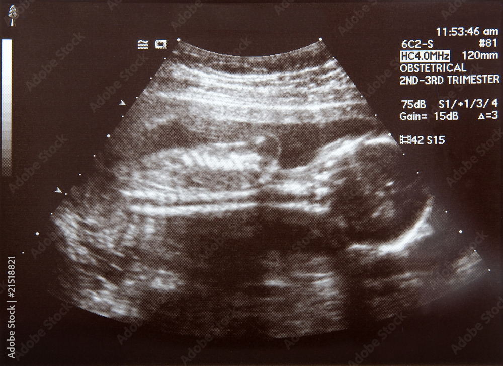 Ultrasound of Fetus Showing Spine Stock Photo | Adobe Stock