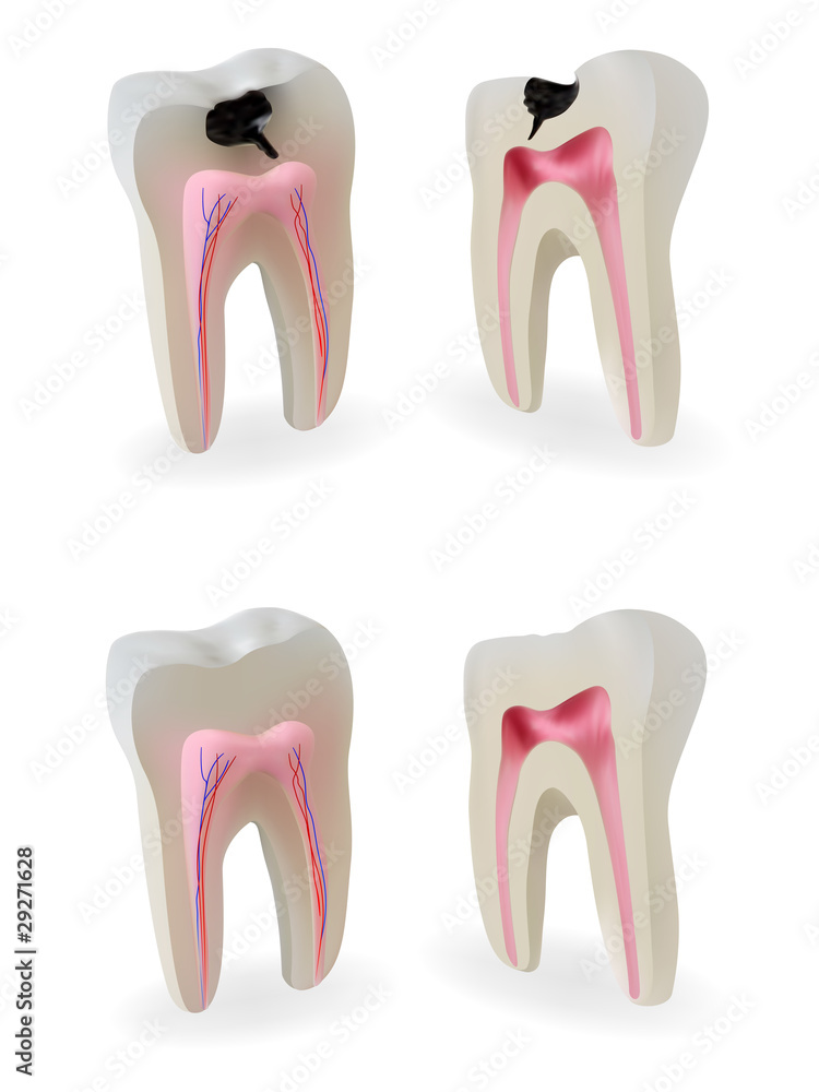 Sound teeth and teeth with caries in section Stock Vector | Adobe Stock