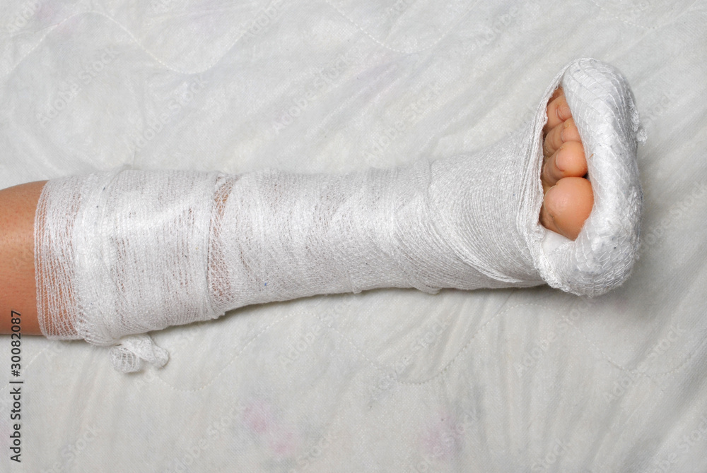 Broken leg Stock Photo | Adobe Stock