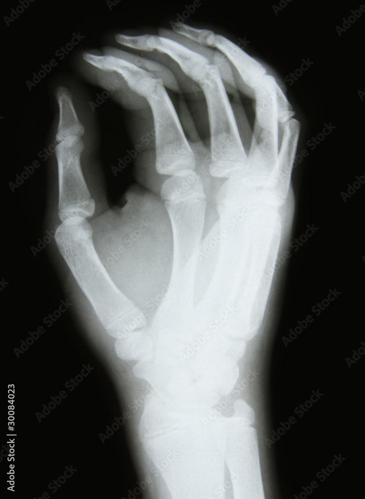 x-ray image of the bones of arm Stock Photo | Adobe Stock