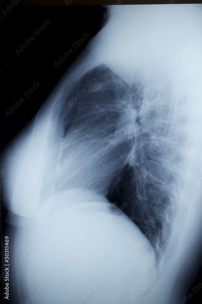 Chest Xray - Lateral View Stock Photo | Adobe Stock