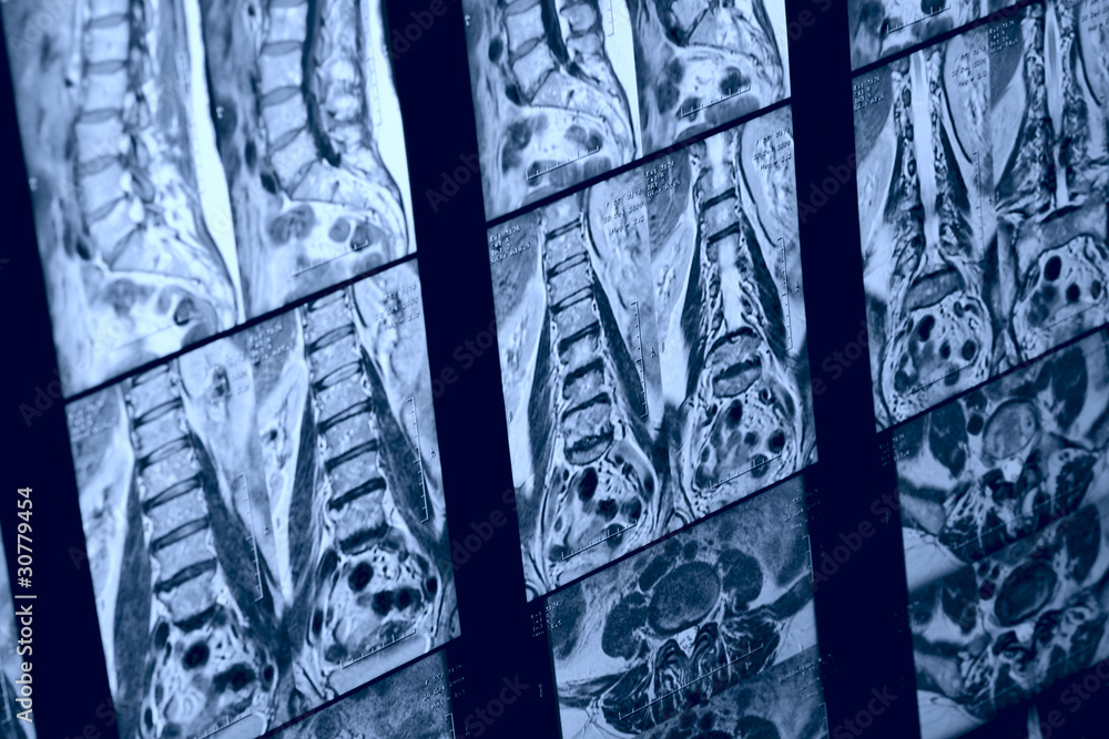 MRI image of human spine Stock Photo | Adobe Stock
