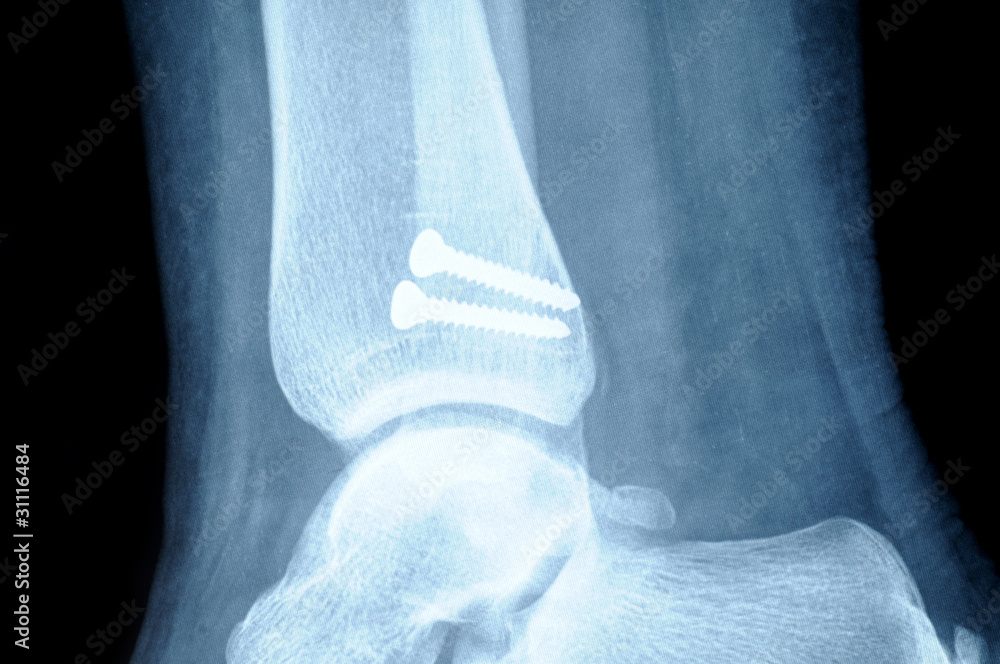 radiograph of human fracture fibula bone Stock Photo | Adobe Stock
