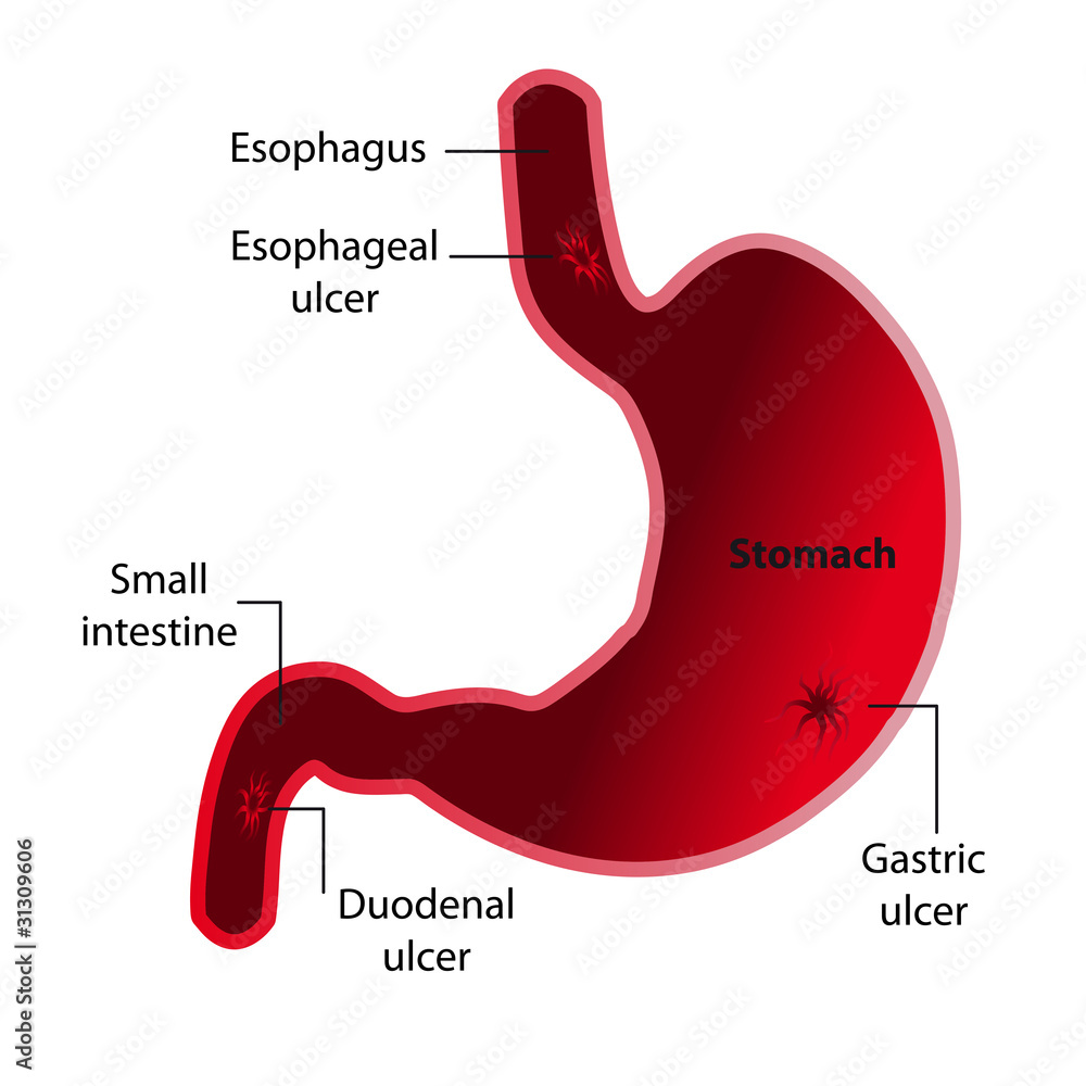 gastric ulcer Stock Vector | Adobe Stock