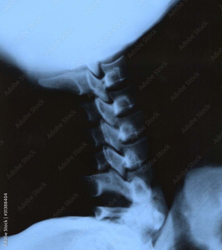 Radiografia del rachide cervicale Stock Photo | Adobe Stock