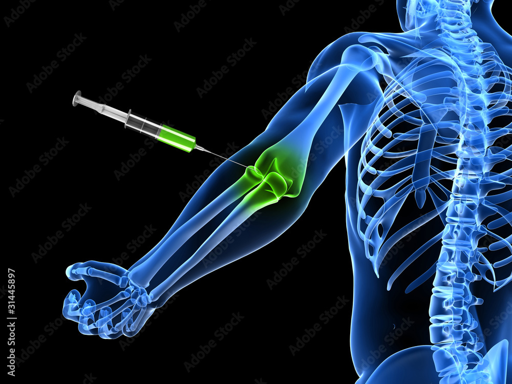 3d rendered illustration showing an elbow joint injection Stock ...
