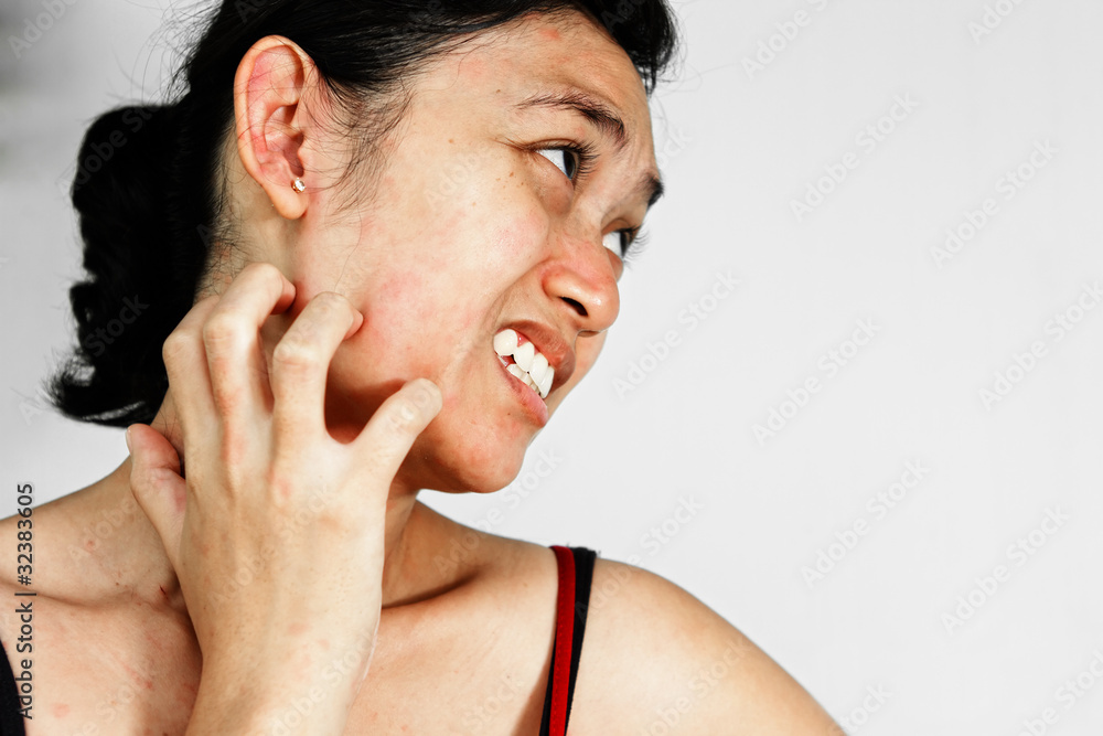 Woman scratch face with skin rash Stock Photo | Adobe Stock