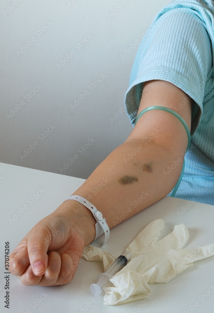 Arm with injection bruises on laboratory table Stock Photo | Adobe Stock