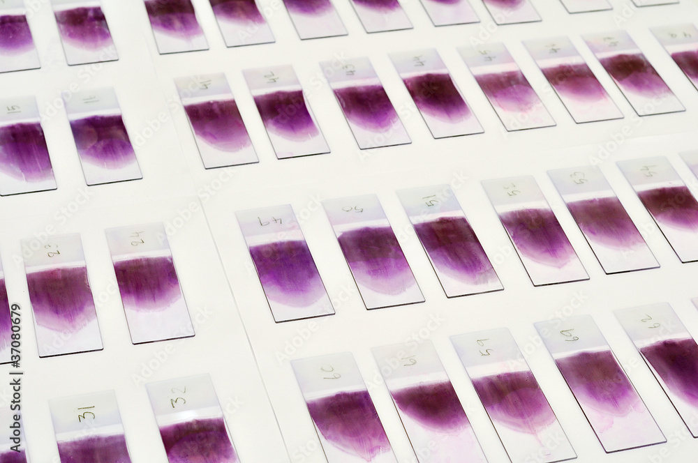 Blood film Stock Photo | Adobe Stock