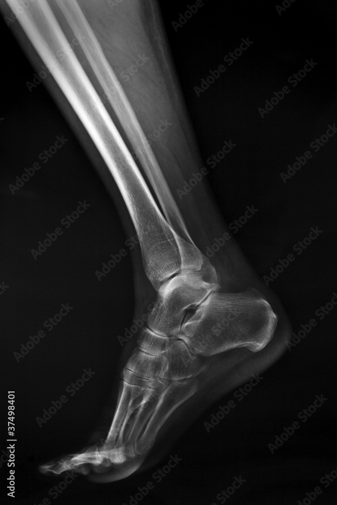 radiografia del piede Stock Photo | Adobe Stock