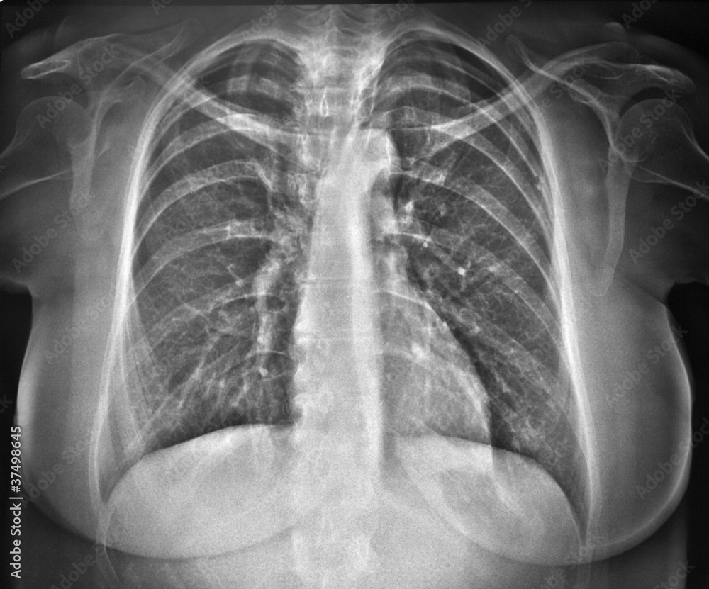 Foto Stock radiografia del torace di donna | Adobe Stock