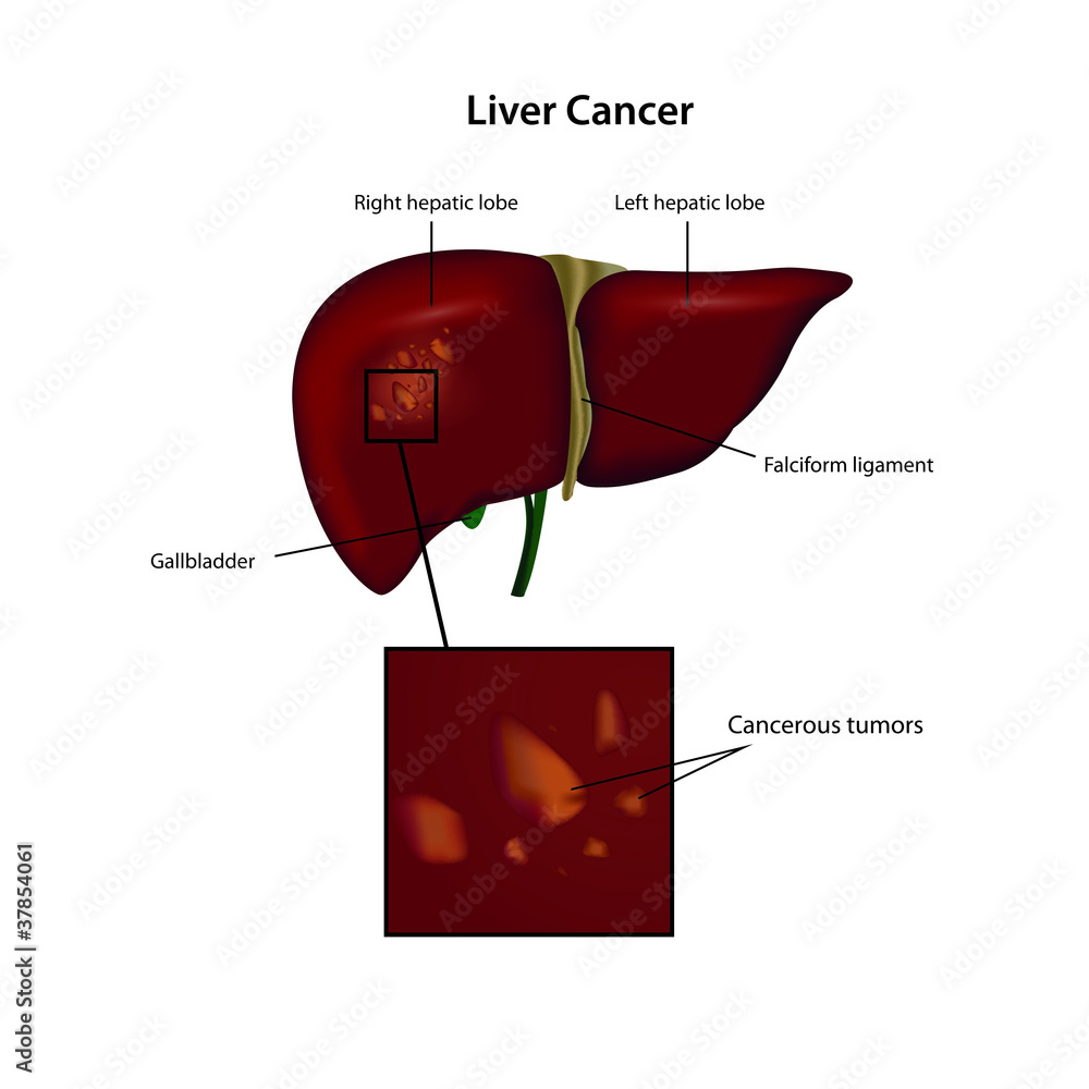 liver cancer vector illustration Stock Vector | Adobe Stock