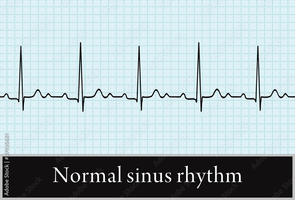 normal sinus rhythm. the vector. Information for professional Stock ...
