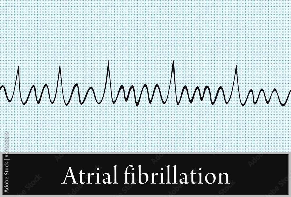 atrial fibrillation. vector. Information for Professionals Stock Vector ...