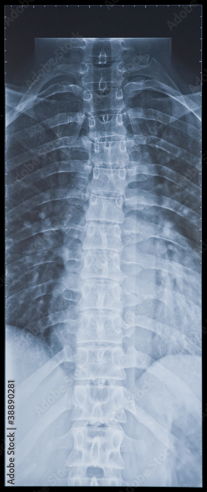 Back X-ray showing scoliosis (curvature). 2 views. Female. Stock Photo ...