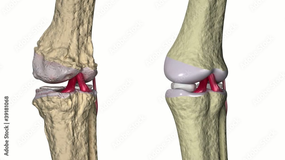 Osteoarthritis : Knee joint with ligaments and cartilages Stock Video ...