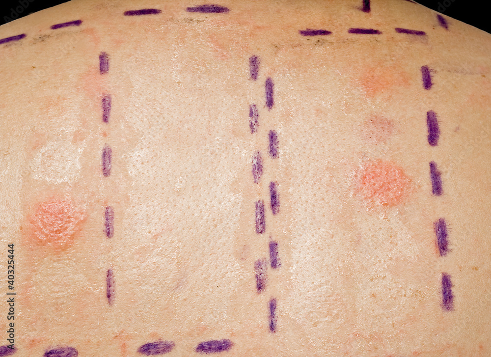 Skin Allergy Patch Test Showing Positive Reaction Stock Photo | Adobe Stock