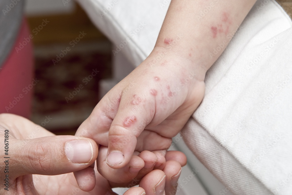 Herpes zoster en la mano de un niño pequeño. Stock Photo | Adobe Stock