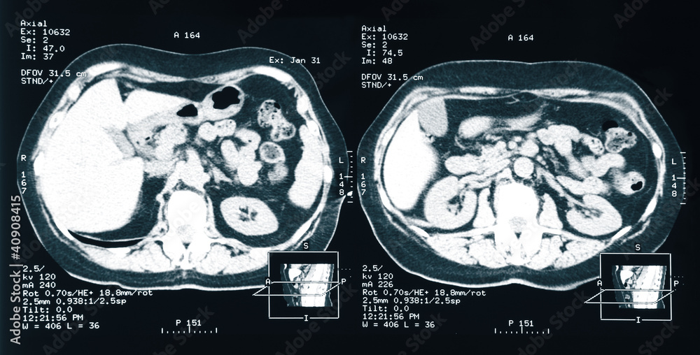 MRI. X-ray of the human kidney Stock Photo | Adobe Stock