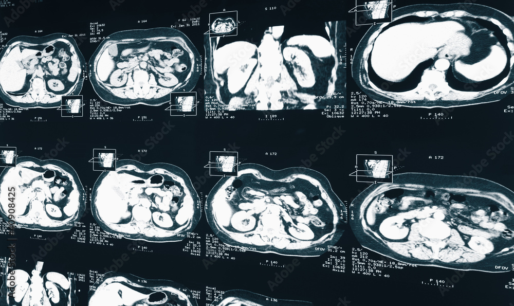 MRI. X-ray of the human kidney Stock Photo | Adobe Stock
