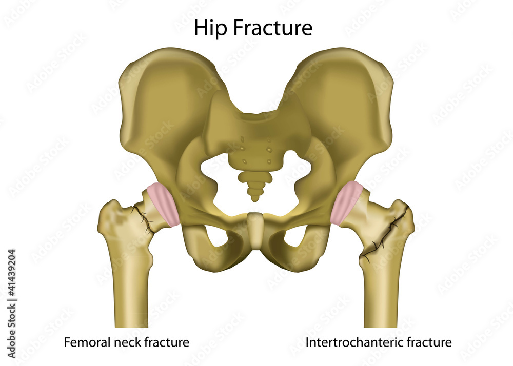 hip joint fracture medical vector illustration,english Stock ...