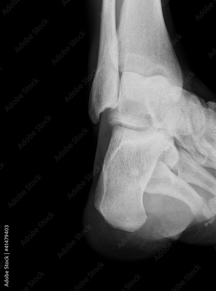 Radiografia piede Stock Photo | Adobe Stock