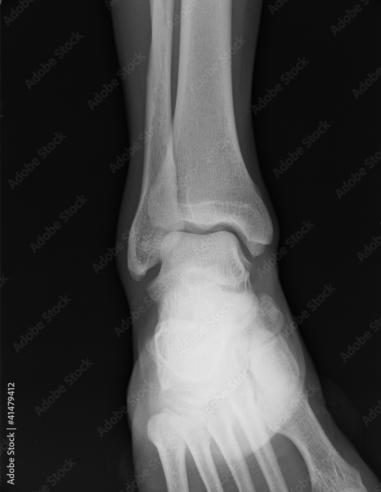 Radiografia piede Stock Photo | Adobe Stock