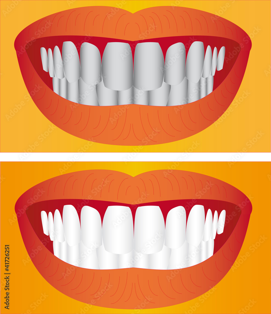 Beautiful young woman teeth before and after whitening. Stock Vector ...