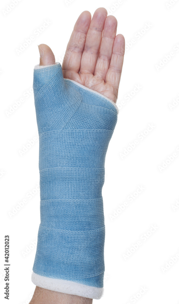 And Blue Wrist Fingers Cast