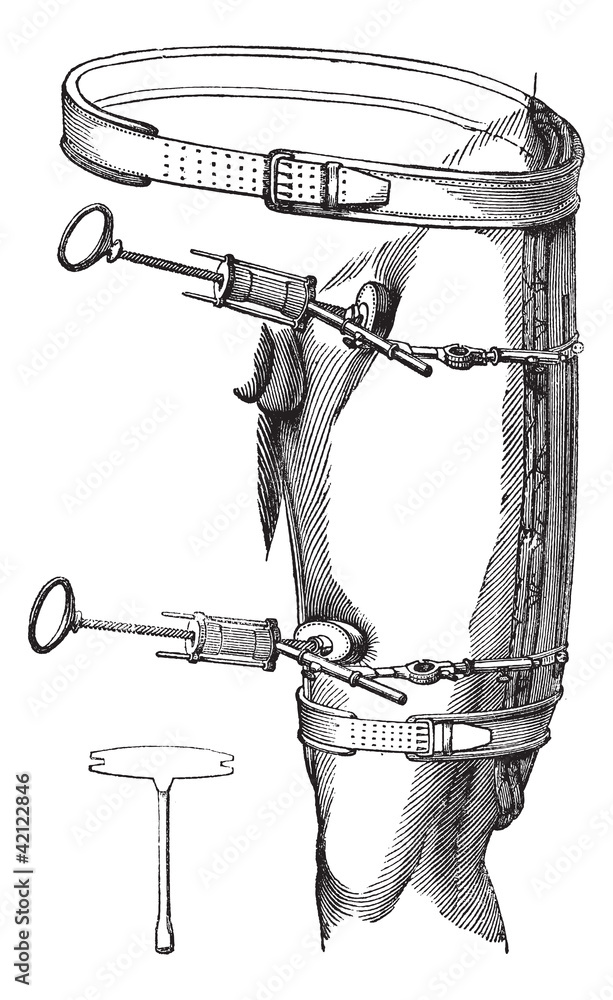 Fig. 89. Leg compression of the aorta using a leg compression to Stock ...
