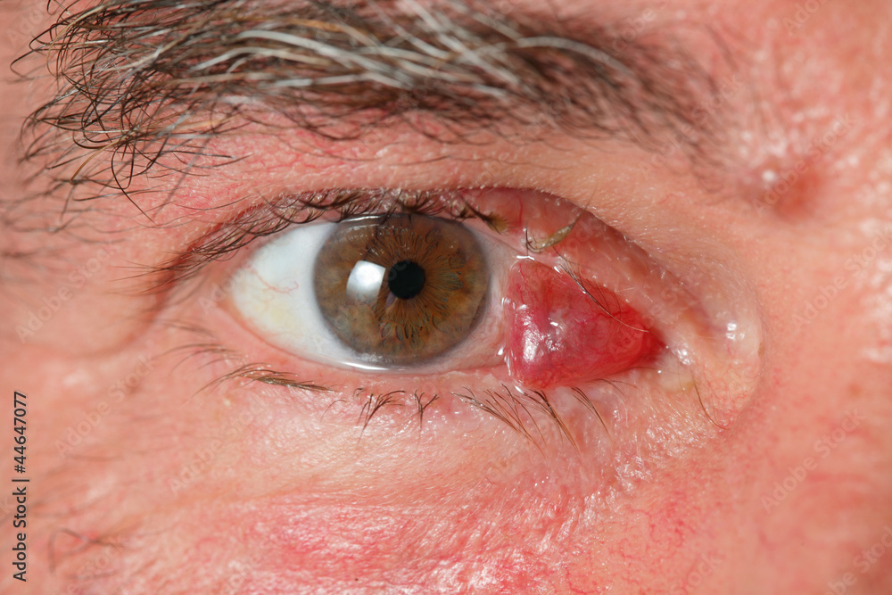 Healthcare, Closeup of human eye with hematoma Stock Photo | Adobe Stock