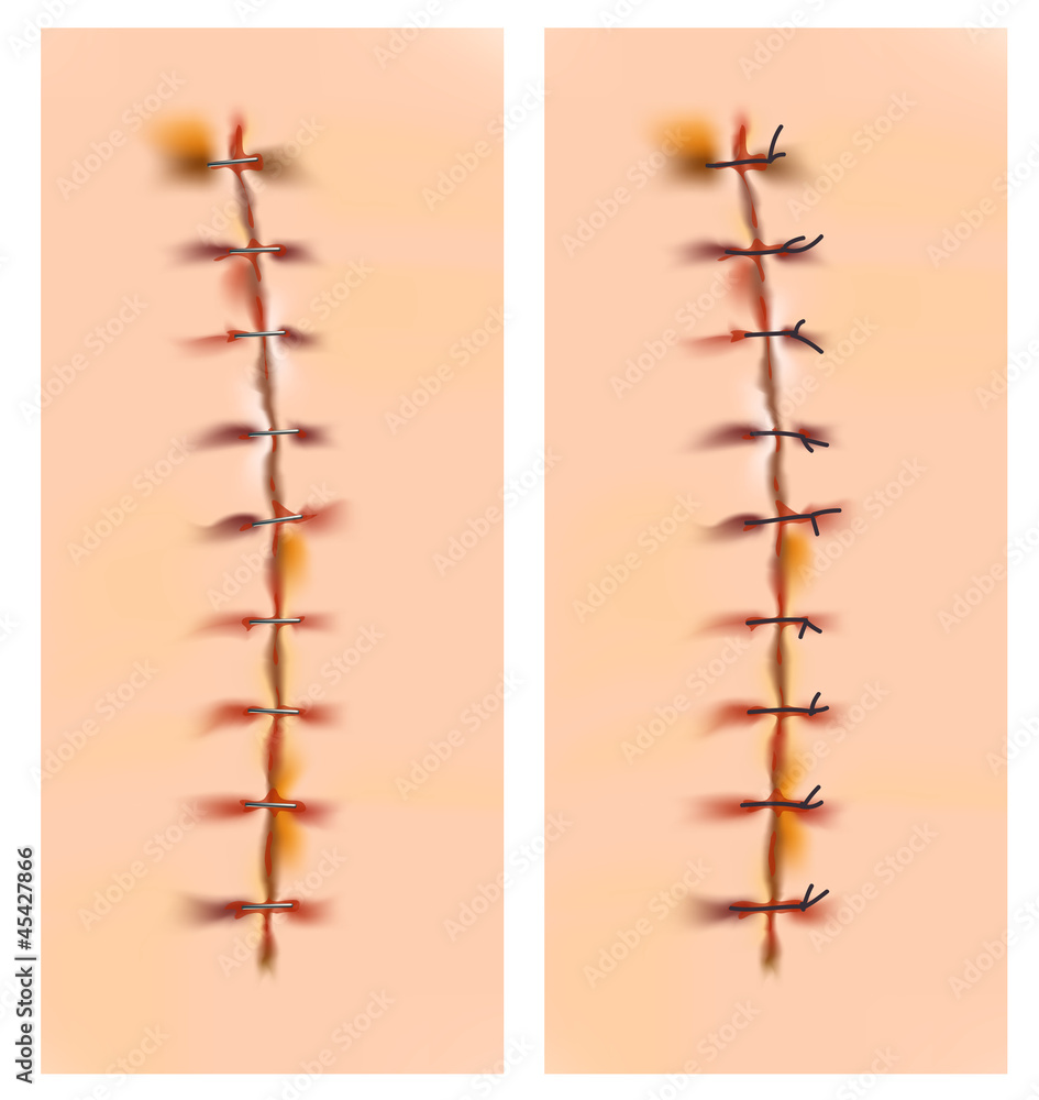 Staples Versus Sutures
