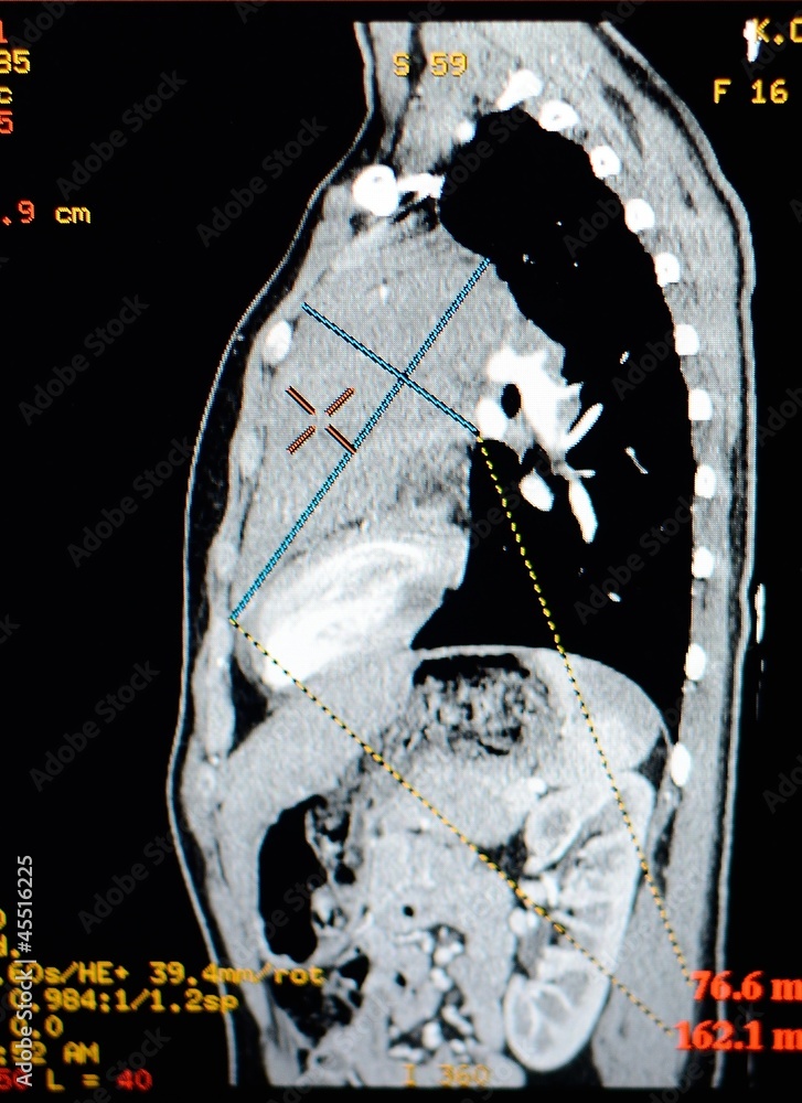 MRI scan of human heart Stock Photo | Adobe Stock