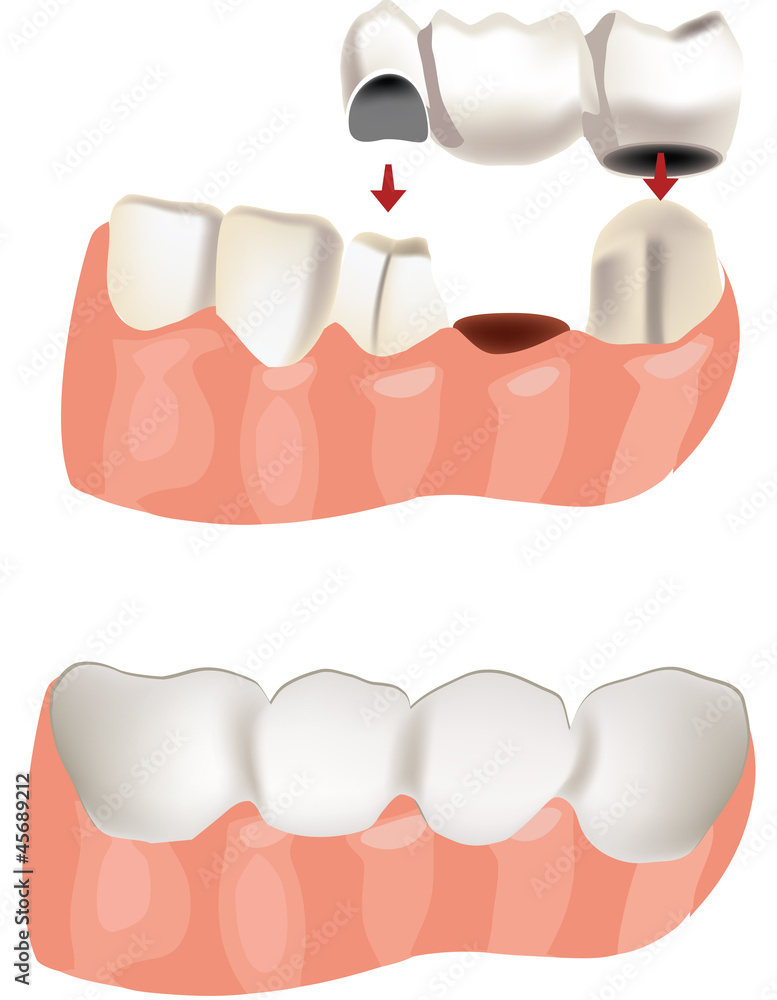 ponte dentale prima e dopo-dental bridge before and after Stock Vector ...