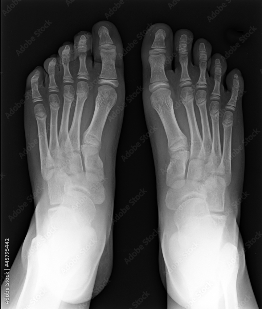Foot fingers exposed on x-ray black and white film, MRI Stock Photo ...