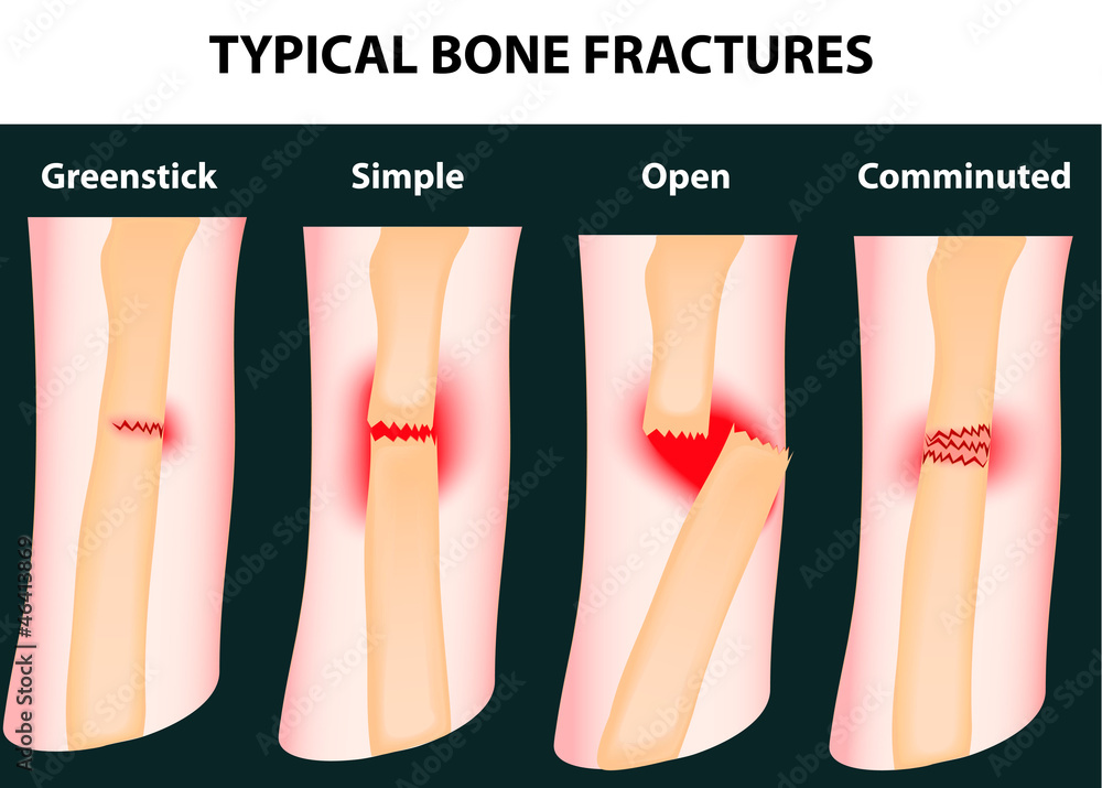Typical bone fractures vector de Stock | Adobe Stock Typical bone fractures vector de Stock | Adobe Stock