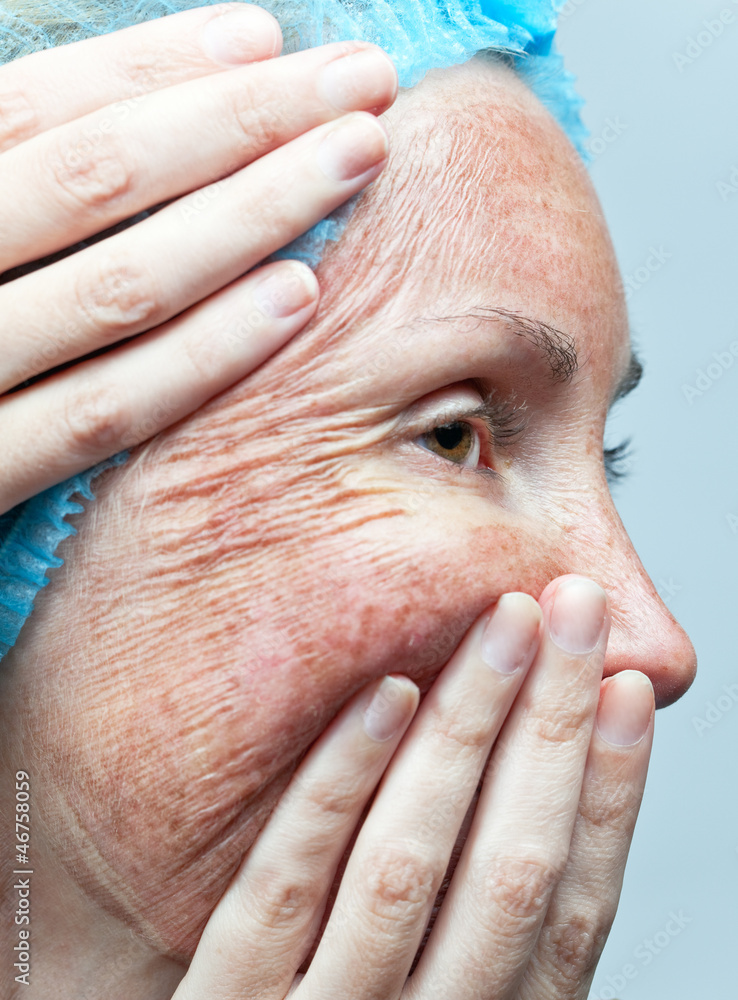 Cosmetology.Chemical peeling.Parchment skin before rejection. Stock ...