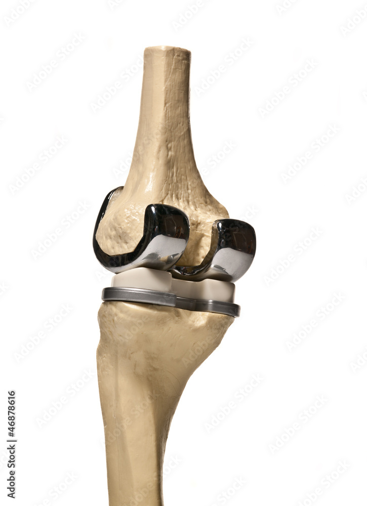 anatomic study model of an human knee replacement Stock Photo | Adobe Stock