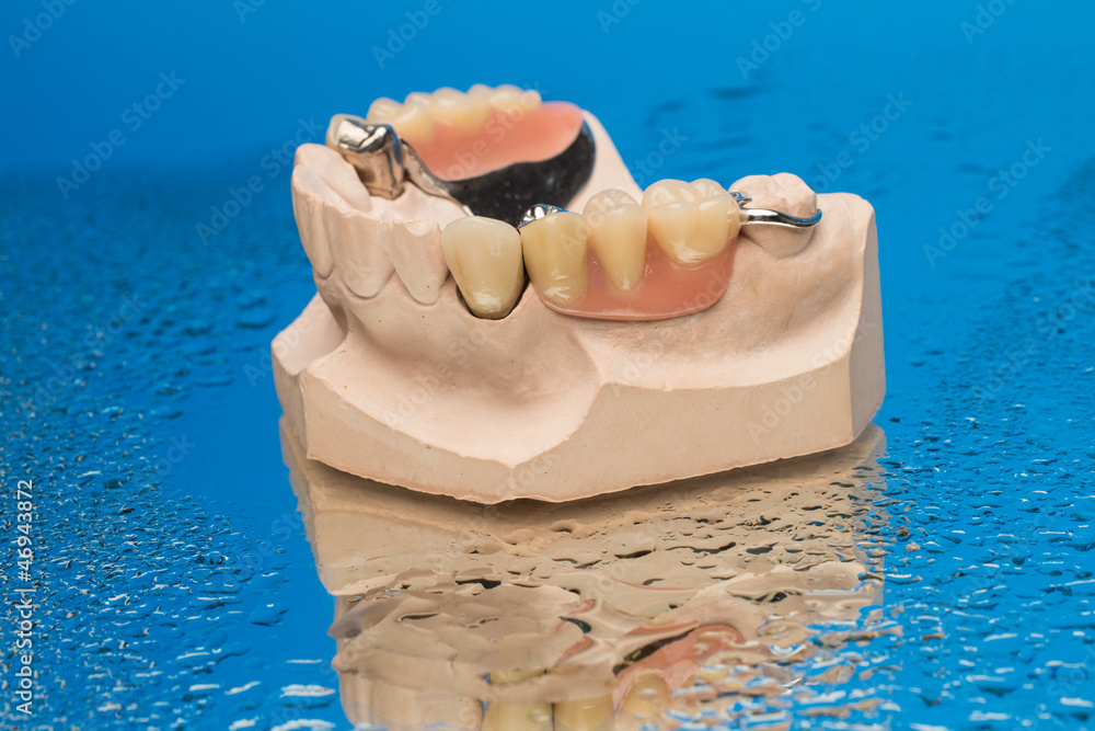 Modellguss Prothese auf blauem untergrund Stock-Foto | Adobe Stock