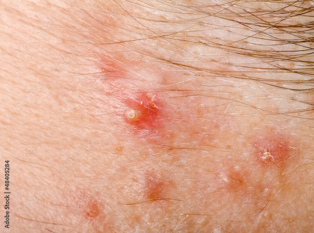 Pimple on human skin macro Stock Photo | Adobe Stock