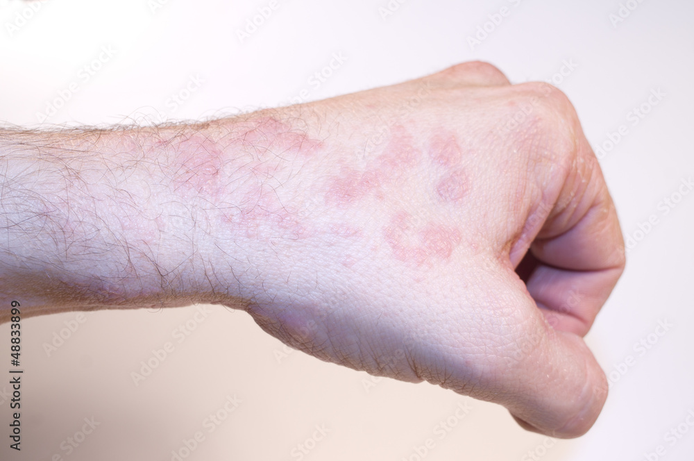 Hautkrankheit linke Hand Faust Stock-Foto | Adobe Stock