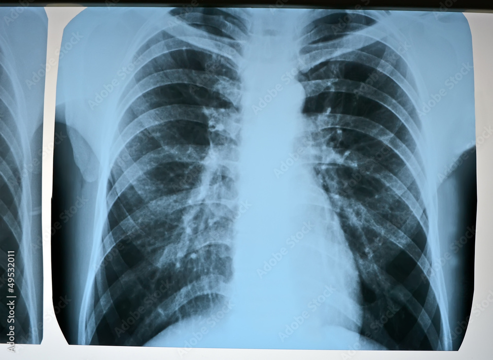 pneumonia test scanning, monkeypox corona virus covid19 infection ...